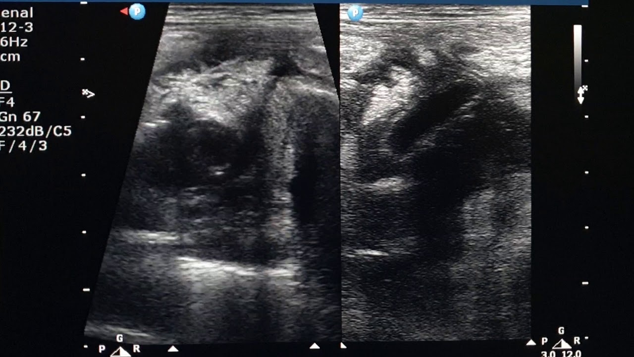 Ruptured Phlegmonous Appendicitis - YouTube