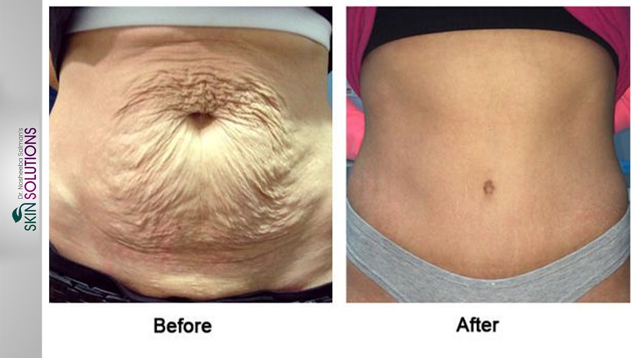 Abdominoplasty (Tummy Tuck) with Liposuction: Transforming Your Body ...