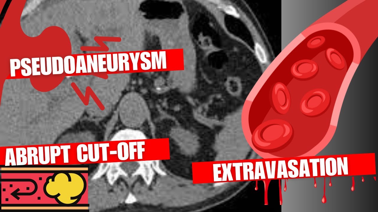 Active bleed on CT - YouTube
