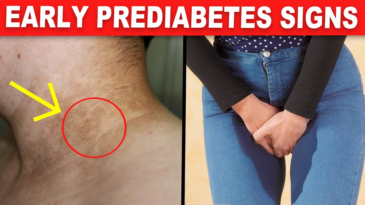 9 Early PREDIABETES Warning Signs You're Unaware Of - YouTube