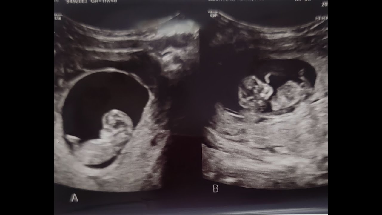 Twin Pregnancy First Trimester - YouTube
