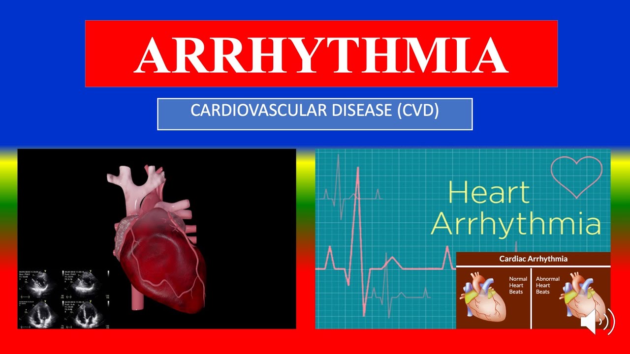 ARRHYTHMIA - Definition, types, cusses, pathophysiology, signs ...