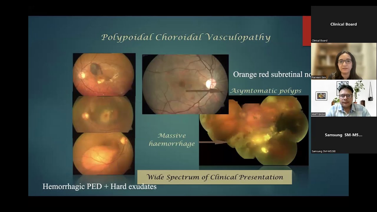 PCV Treatment Paradigms - YouTube