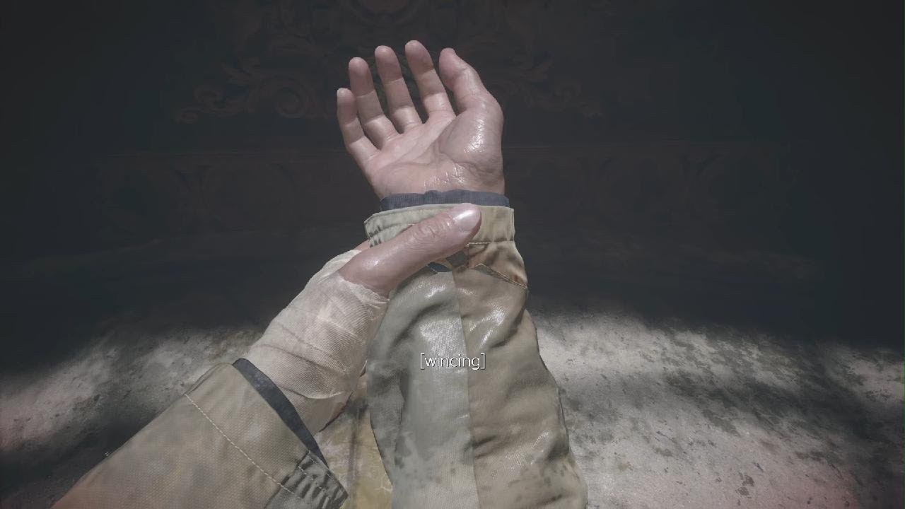 And thats how you Reattach a severed hand - YouTube