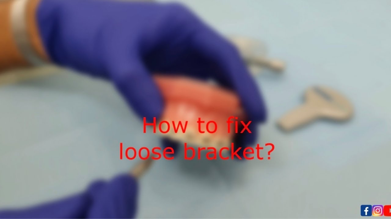 How to fix a loose Damon bracket? - YouTube