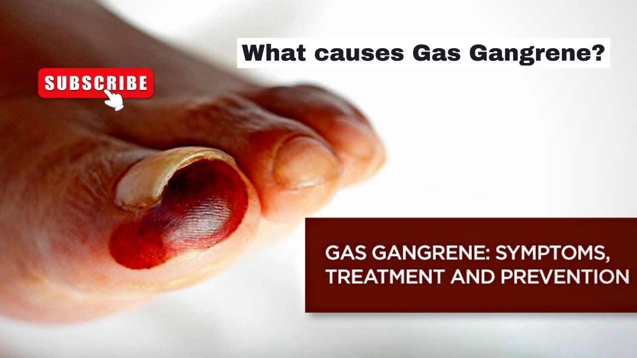 What is a Gas Gangrene? Symptoms - YouTube