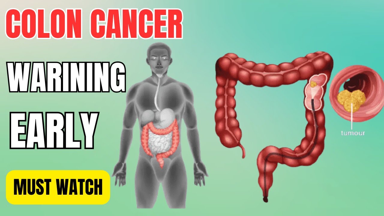Top 10 Early Warning Signs of Colon Cancer [Warning] - YouTube
