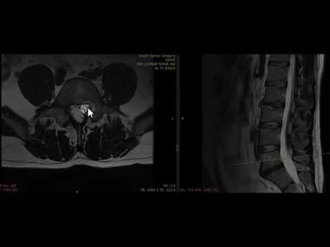Find Specific Nerve Roots on a Lumbar MRI - YouTube