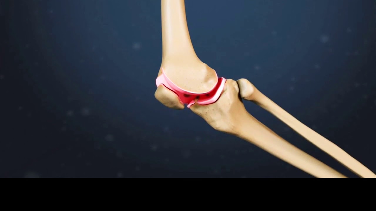 ANIMACION RODILLA 2 H264 MP4 Dyn 1920 1080p 25fps 8000kbps 16x9 - YouTube