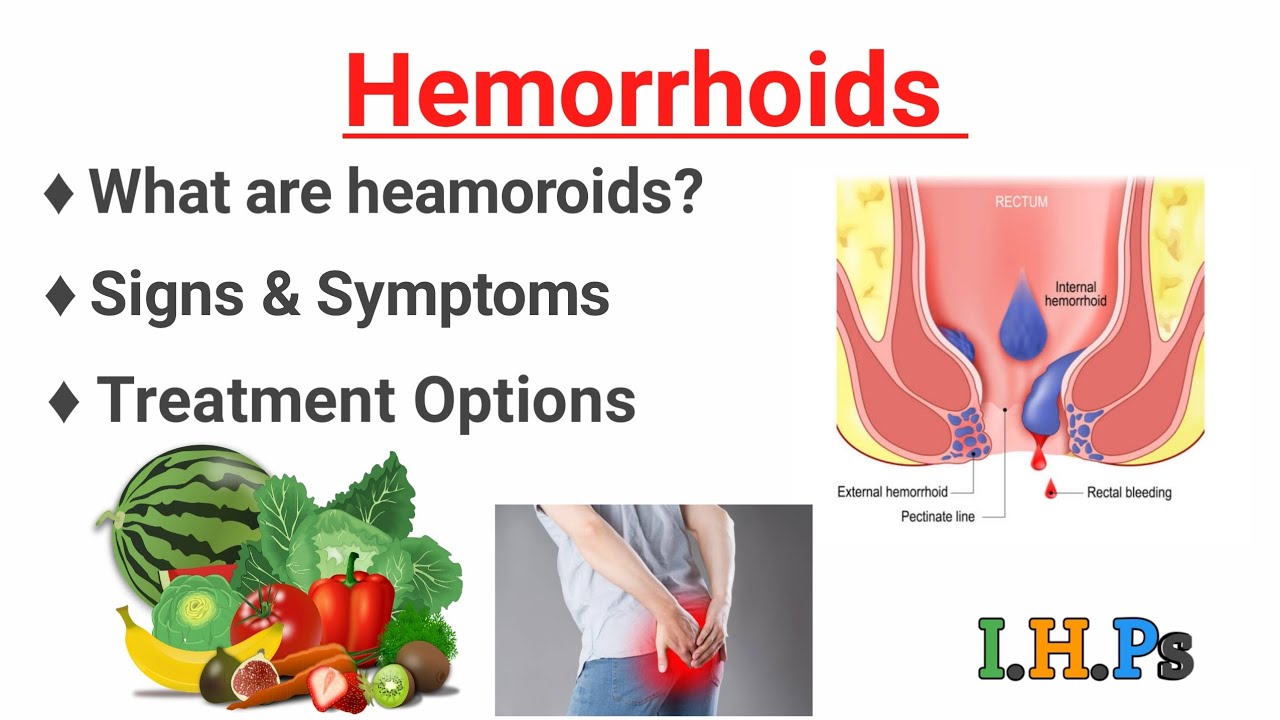 Hemorrhoids What Are Hemorrhoids Signs And Symptoms Treatment