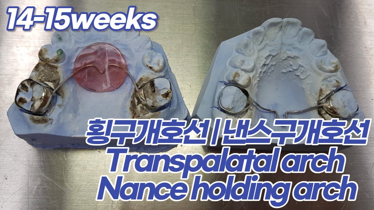 [Orthodontic|교정] 횡구개호선&낸스구개호선 | Transpalatal arch&Nance holding arch ...