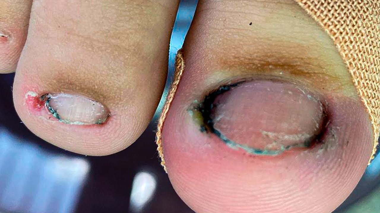 REMOÇÃO DE PÚS DA UNHA INFLAMADA | Podóloga Renata Cavalcanti - YouTube