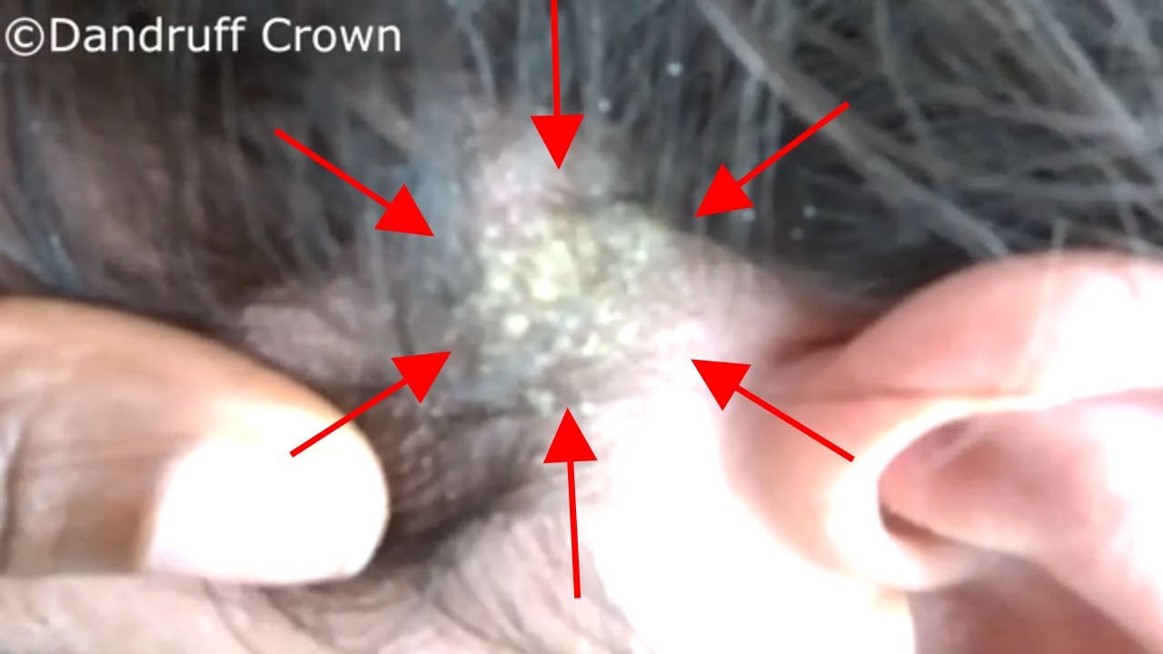 Babe´s SCALP CHECK || DANDRUFF Scratching - YouTube