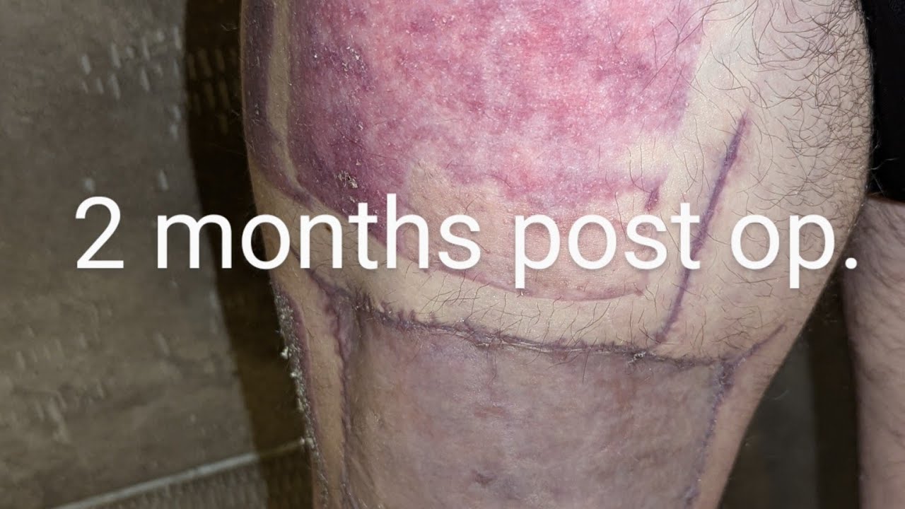 Leg update, 2 months post op FTM Bottom surgery 🏳️‍⚧️ - YouTube