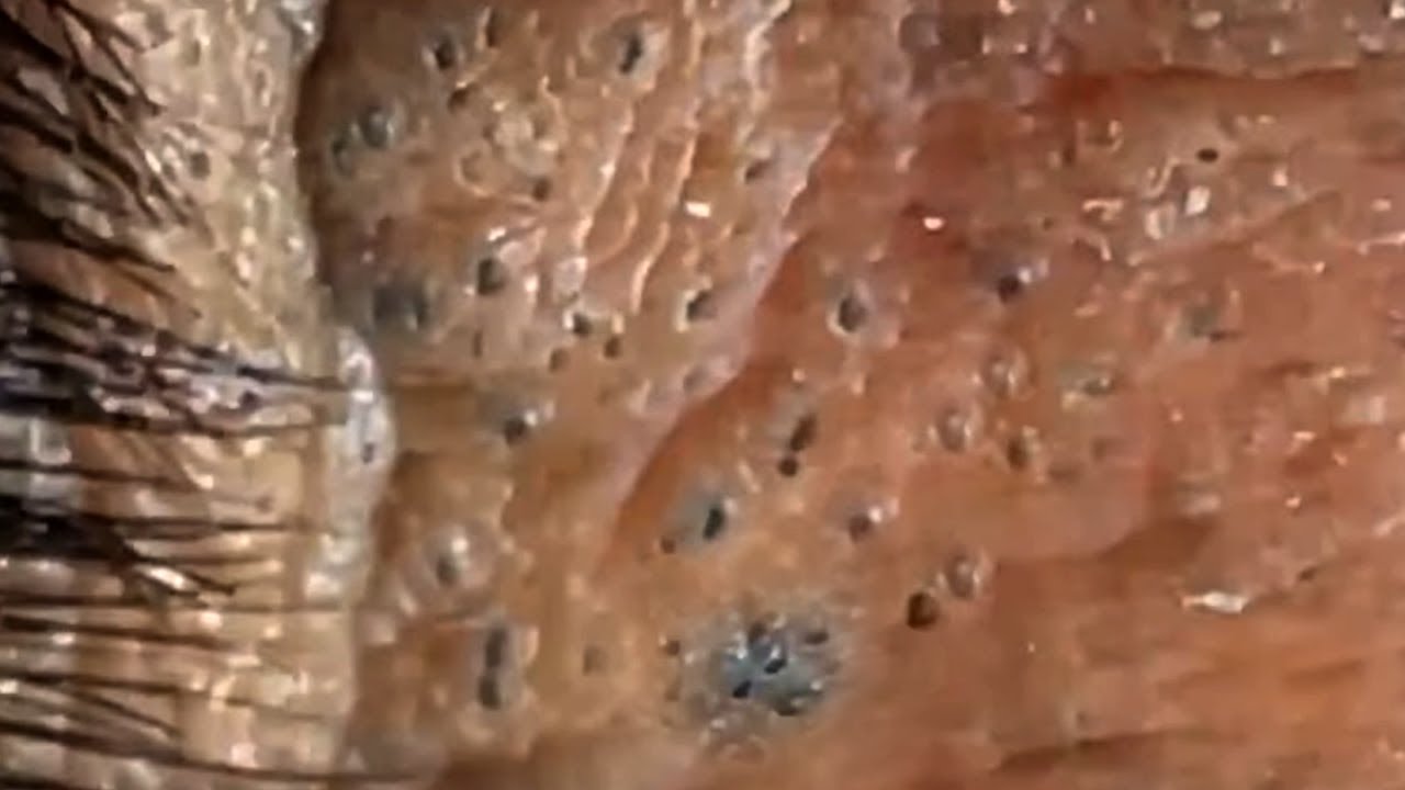 Satisfying Acne and Pimple Removal Blackheads & Whiteheads #1212 - YouTube