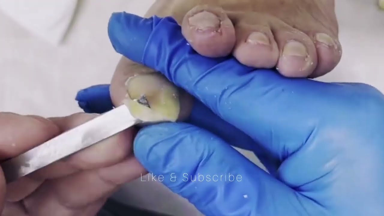 Cut Big Dirty Ingrown Toenail 517 剪大脏向内生长脚趾甲 #health #shorts - YouTube