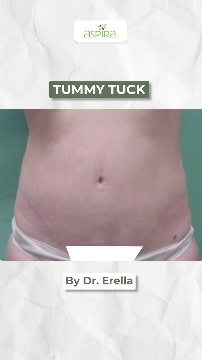 Tummy Tuck Transformation by Dr. Erella #TummyTuck - YouTube