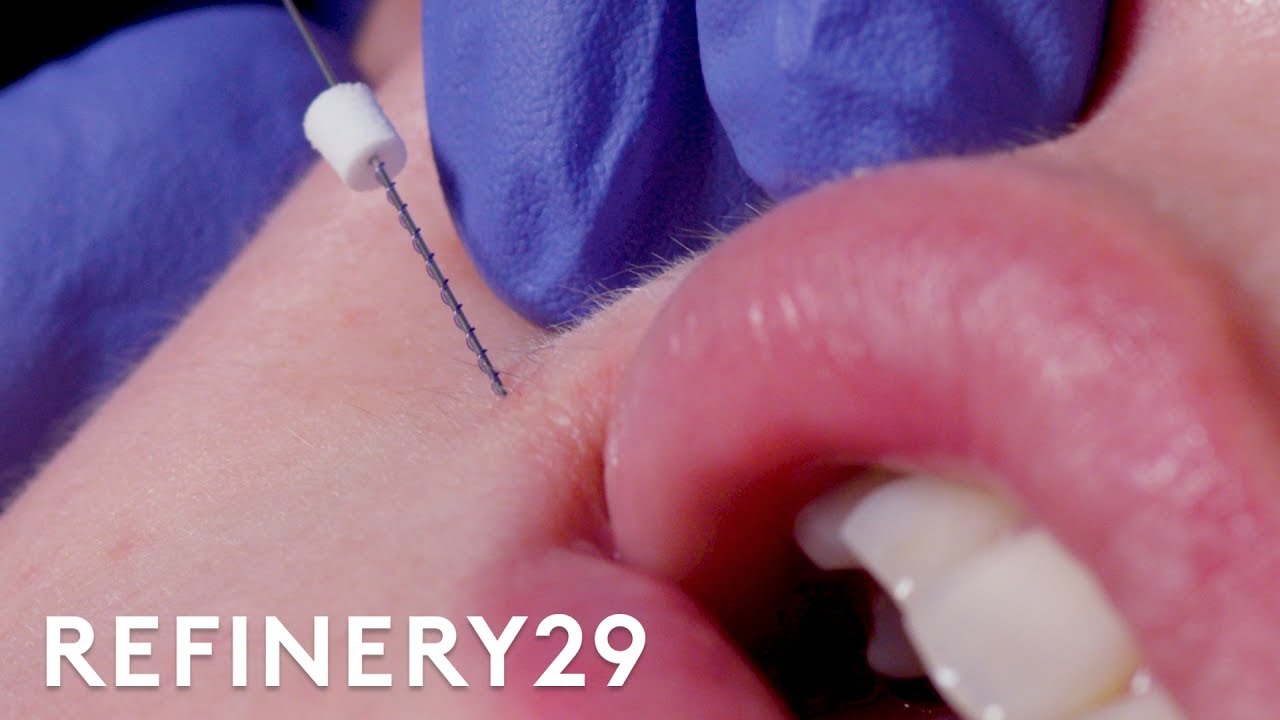 I Got Threads Injected Into My Lips | Macro Beauty | Refinery29 - YouTube