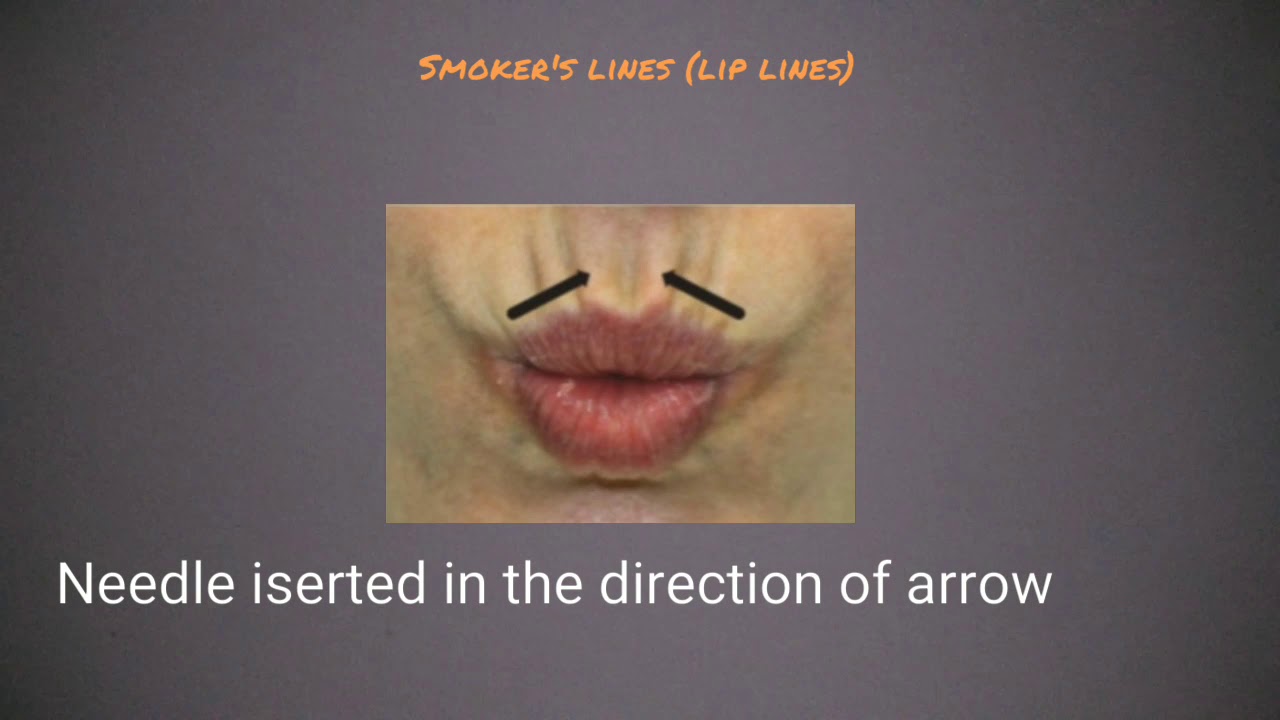 Botox for smoker lines - YouTube
