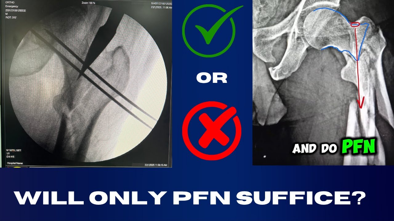 PFN ENTRY POINT SECRET - YouTube