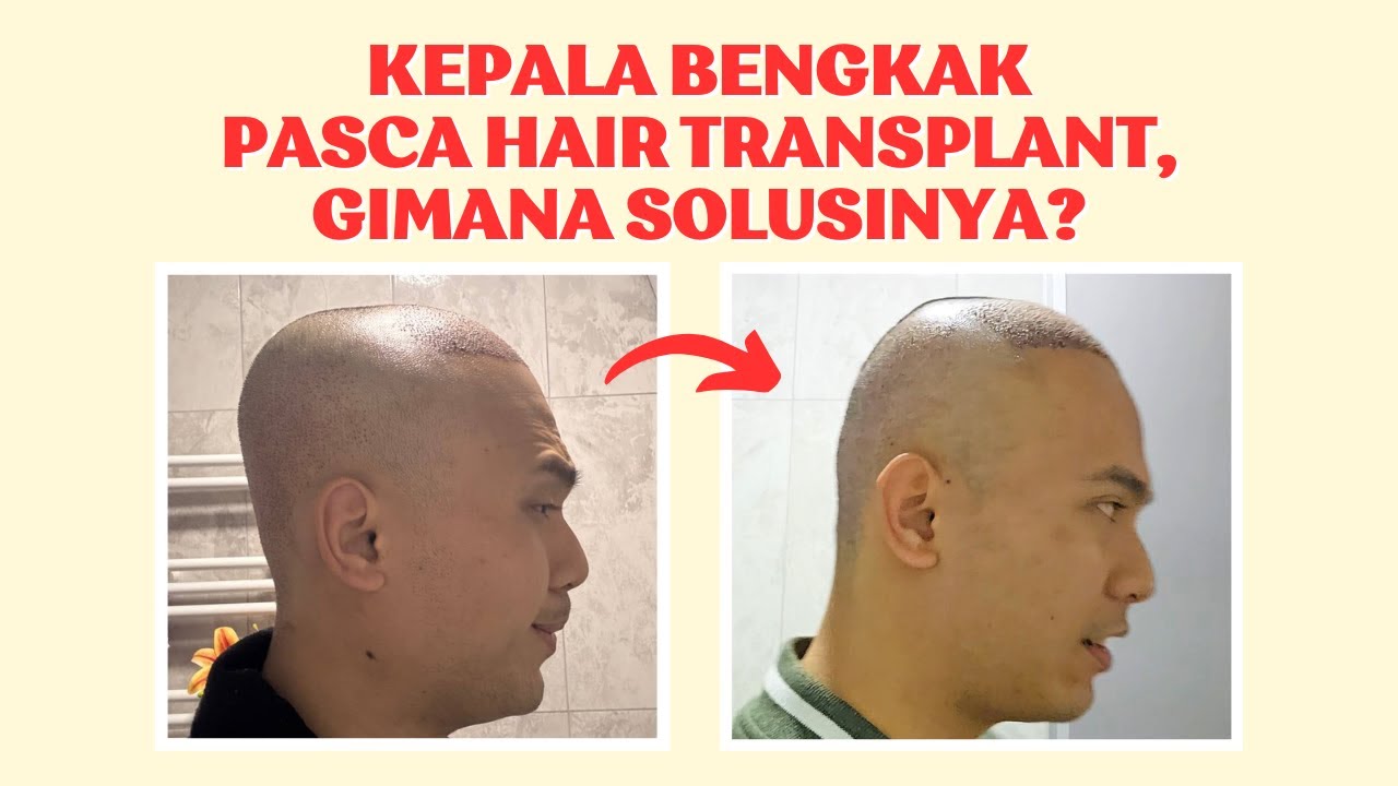 UPDATE HARI KE 6 PASCA TANAM RAMBUT DI VEGA HAIR CENTER ISTANBUL TURKI ...
