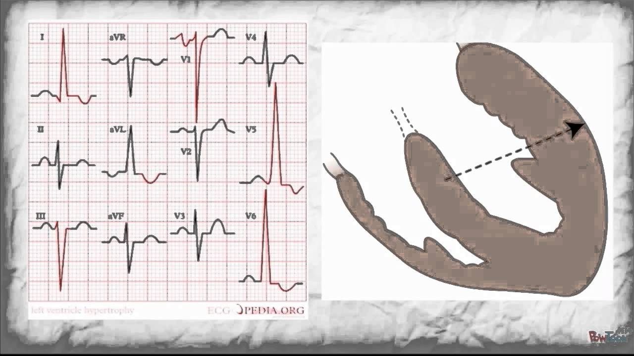 How to Read a Pediatric EKG - YouTube