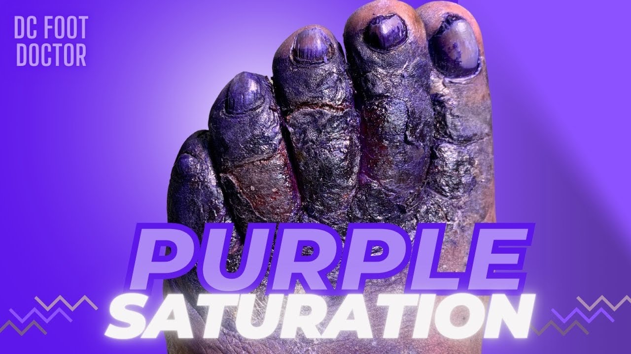 Purple Saturation: Fungal and Bacterial Infection Over-treated with ...