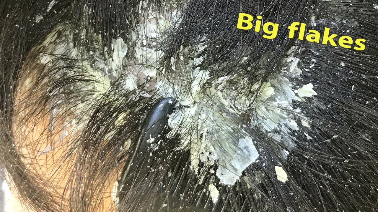 Big flakes || Dandruff Scratching Scalp || Itchy Dry Scalp Treatment ...