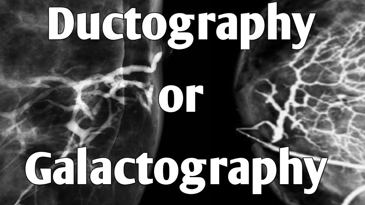 Ductography or Galactography in Bengali - YouTube