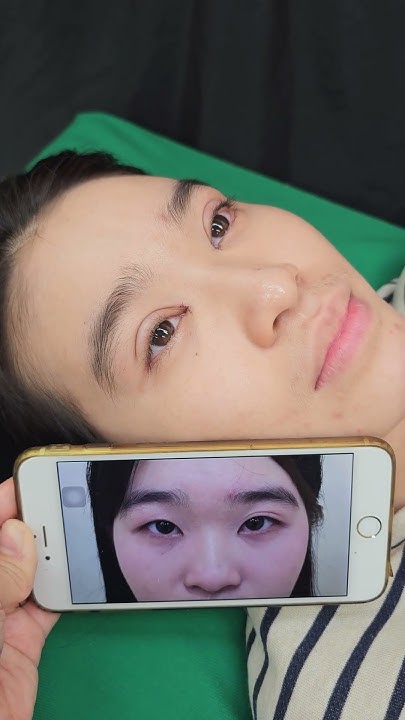 31.Combo Cắt mí Double Deep + Mở rộng góc mắt trong DR Vĩnh - Thẩm mỹ Chợ rẫy 0905388576 - YouTube