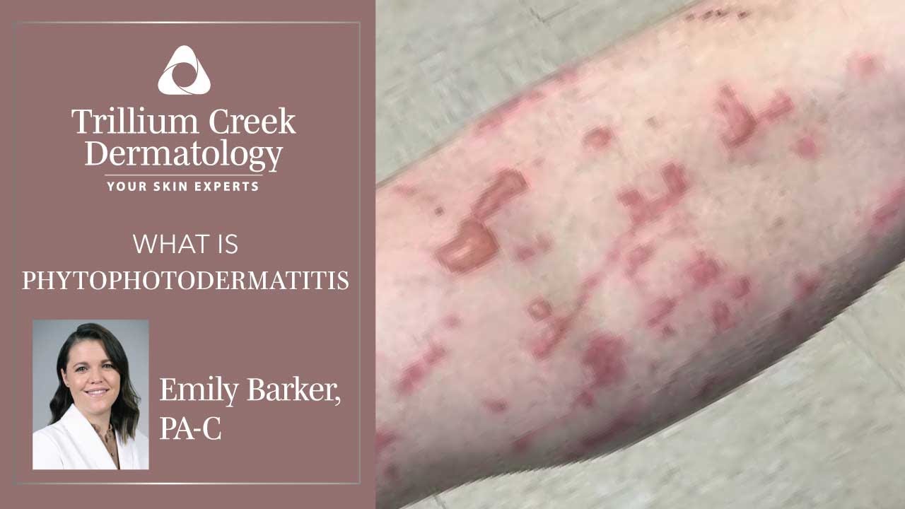 What is Phytophotodermatitis? - YouTube