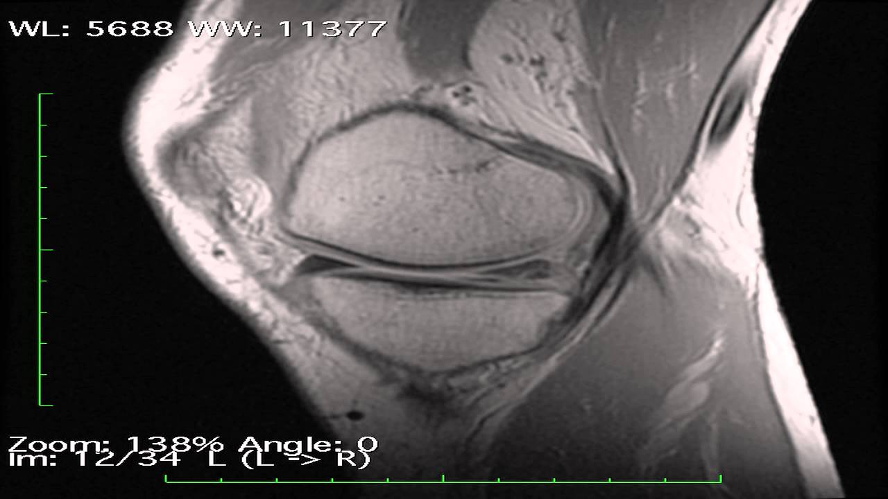 Medial Meniscus Tear MRI 8 - YouTube