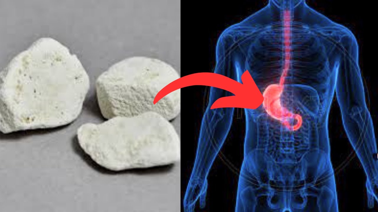 Milk Alkali Syndrome Symptoms, Causes, Treatment What is Milk Alkali ...