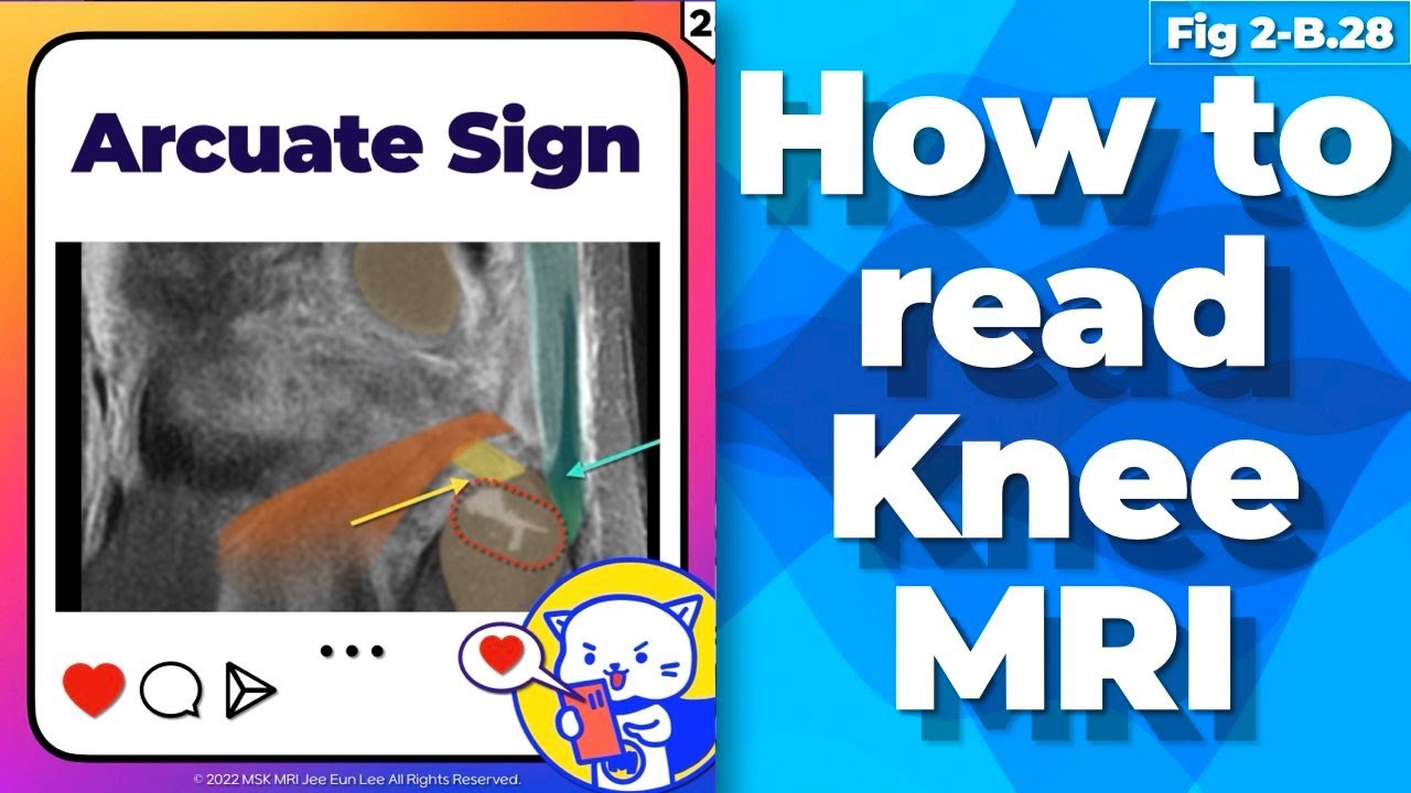 (Fig 2-B.28) Avulsion fractures of the fibular head (arcuate sign ...