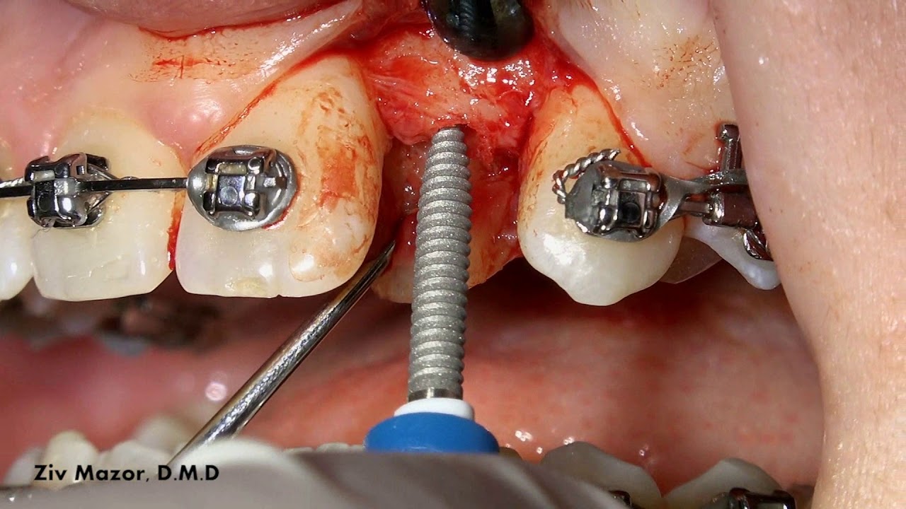 Dr. Ziv Mazor Uses Dentatus ANEW Narrow Diameter Implant - YouTube