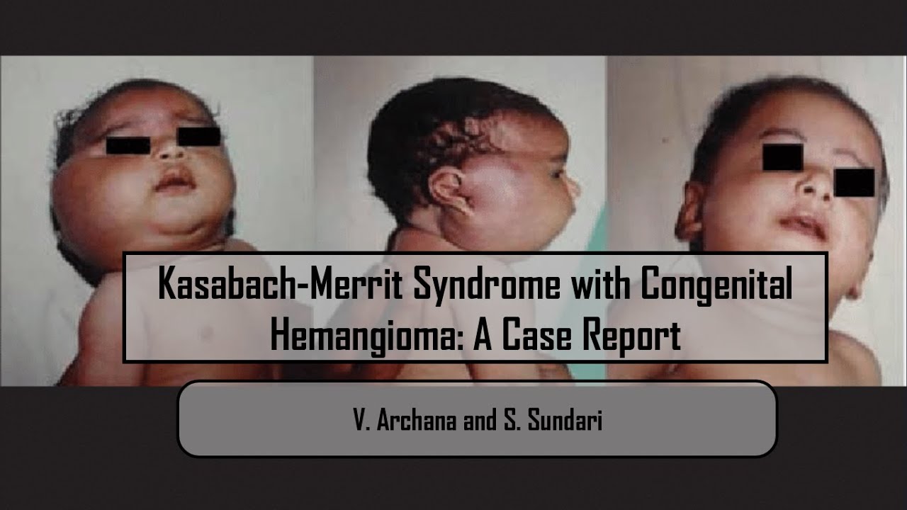 Kasabach-Merrit Syndrome with Congenital Hemangioma: A Case Report ...