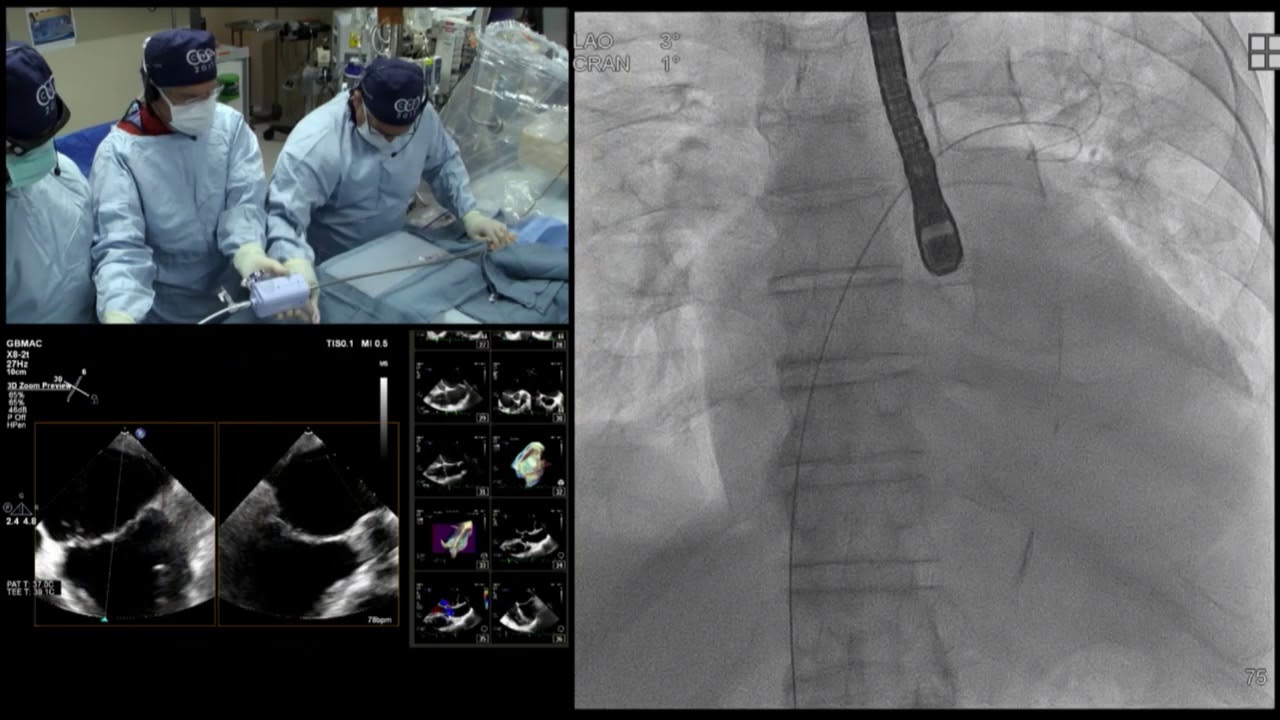 LIVE STRUCTURAL HEART DISEASE CASE Telecast from University of ...