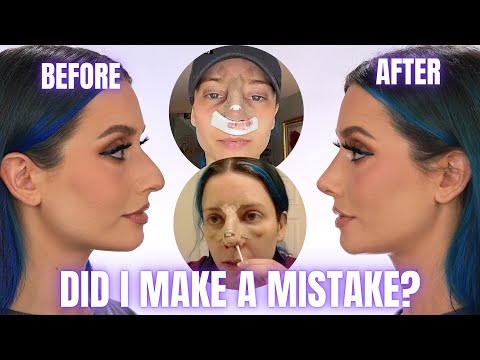 CLOSED RHINOPLASTY NOSE JOB VLOG | SURGERY DAY, DAY BY DAY RECOVERY ...