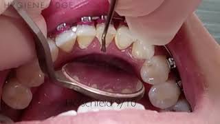 How To Use A Tooth Slooth | Doovi