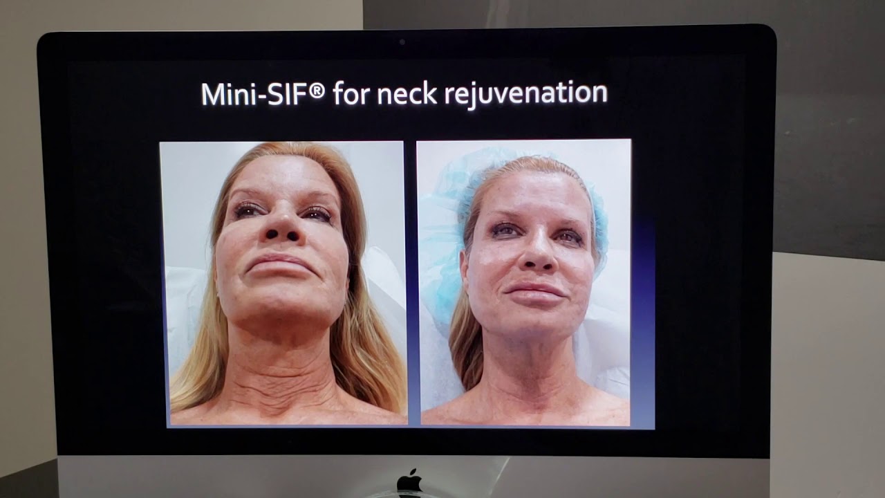 Mini-SIF™ Dr. Khan's proprietary Technique for Restoration of Facial ...