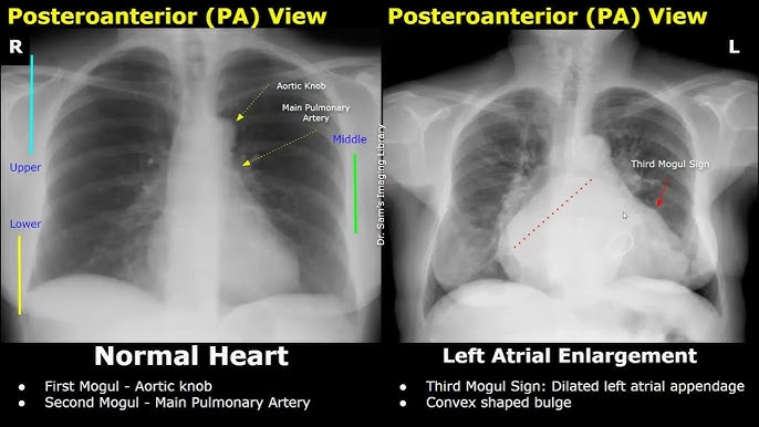 Normal Chest X Ray Labelled Anatomy Pa View Part 1 Cxr 46 Off