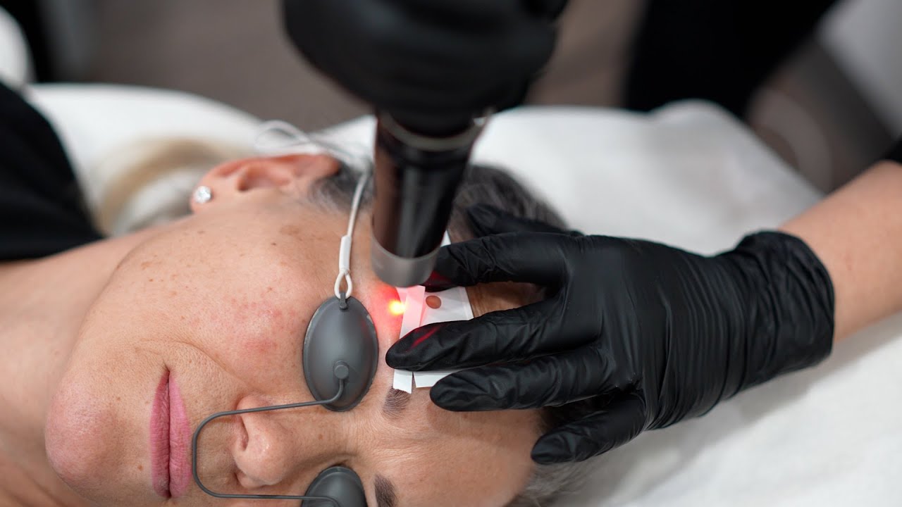 Microblading Removal in Winnipeg | PicoSure Laser Brow Correction - YouTube