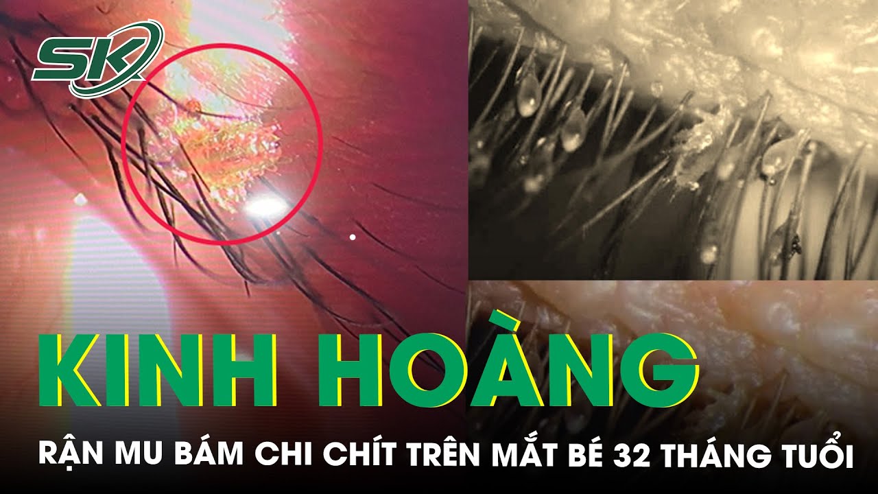 Kinh Hoàng Rận Mu Bám Chi Chít Trên Mắt Bé Trai 32 Tháng Tuổi | SKĐS ...