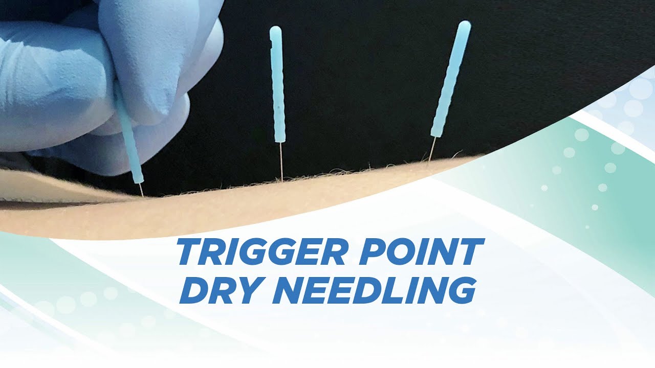 Relieve Pain & Restore Mobility with Trigger Point Dry Needling Therapy ...