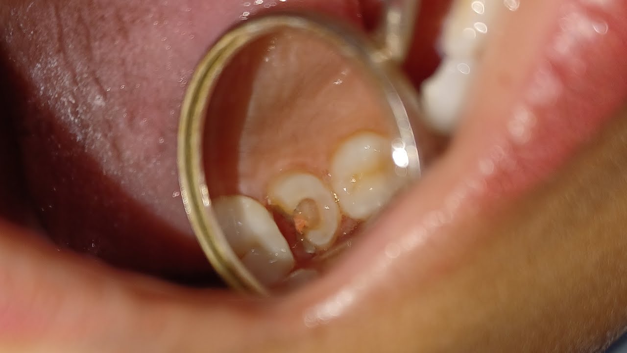 RCT (root canal treatment)w.r.t 15(maxillary 2nd premolar) followed by ...