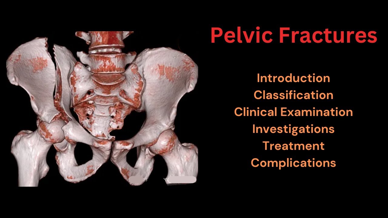 Pelvic fractures: Introduction, Classification, Examination, Treatment ...