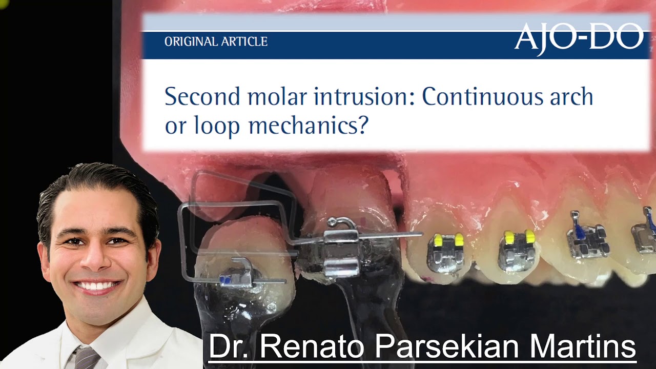 Second Molar Intrusion: Continuous Arch or Loop Mechanics? - YouTube