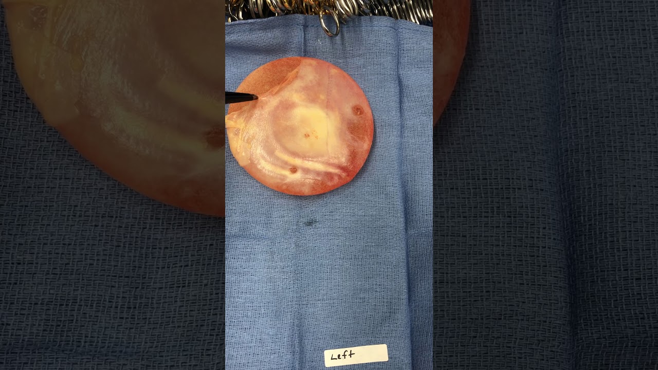 Explant and En Bloc Capsulectomy | Gary Rosenbaum, M.D. - YouTube