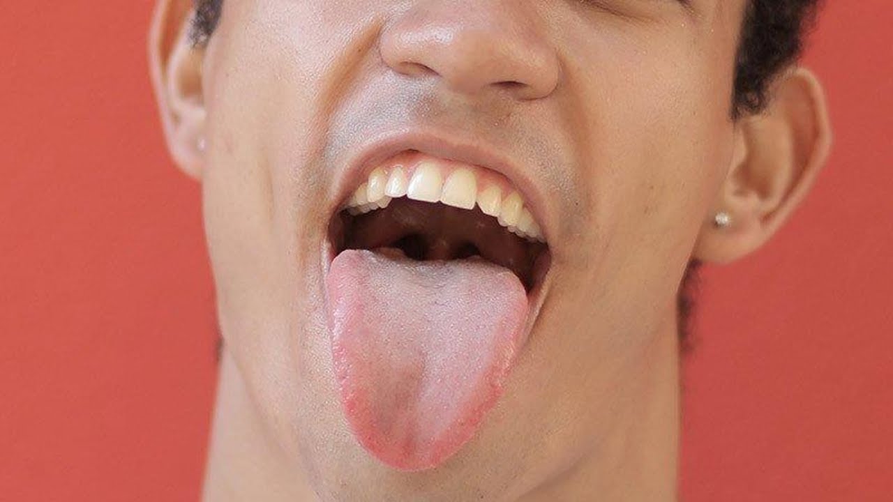 CLINICAL SIGNIFICANCE OF WET & SLIPPERY TONGUE COATINGS IN CHINESE ...