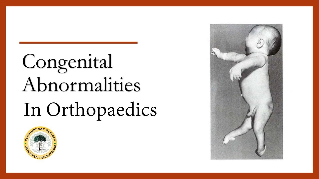 Chapter 8: Congenital Abnormalities In Orthopaedics (Part 1) - YouTube